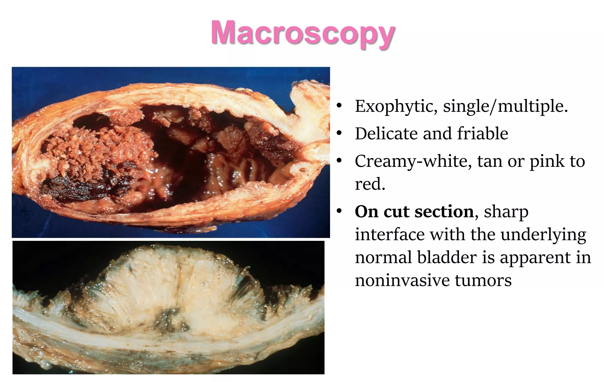 URINARY BLADDER TUMORS.pdf