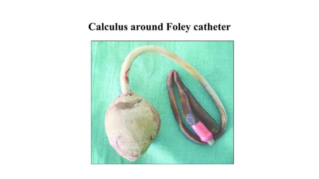 Urinary Calculi.pptx | Digestive Disorders | Diseases and Conditions