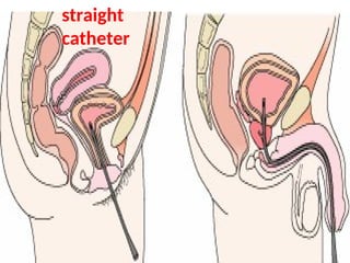 Urinary Catheterazation Medical And Surgicalppt Ppt