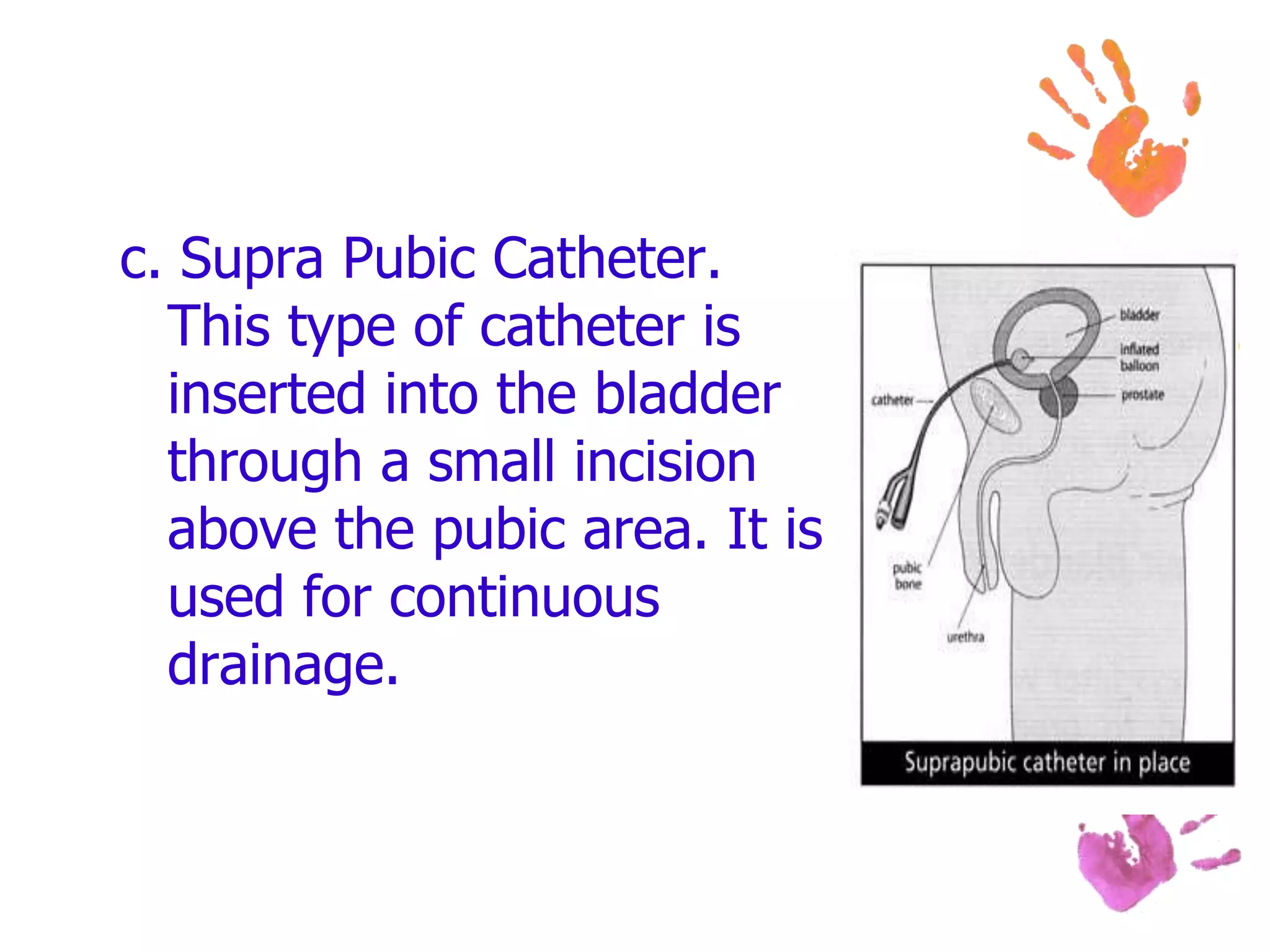 Urinary Catheterization | PPTX
