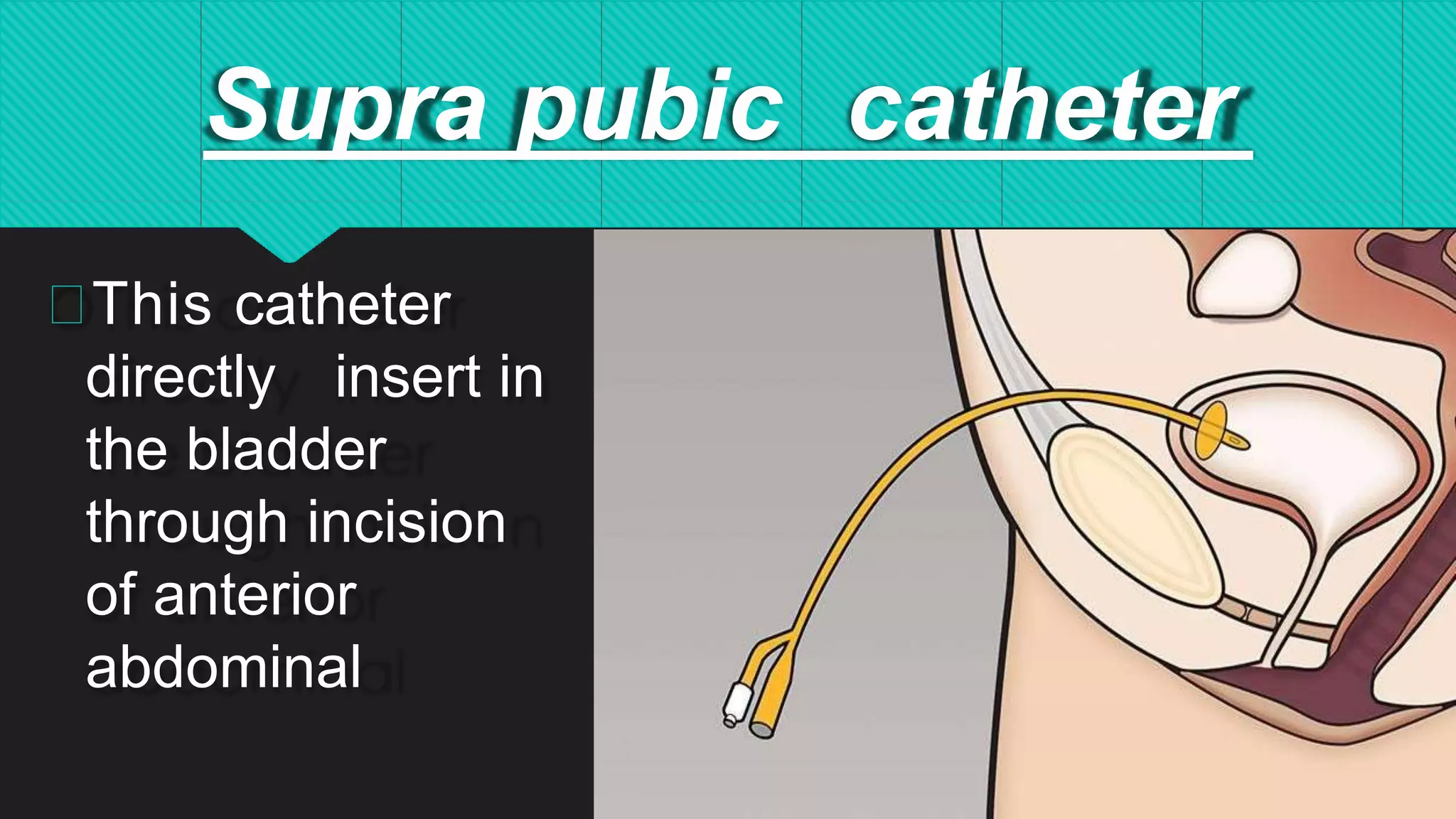 Urinary Catheterization Pptx