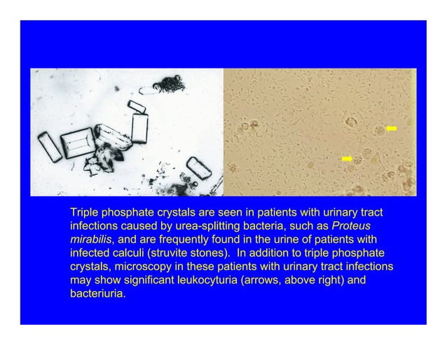 Urinary crystals | PDF