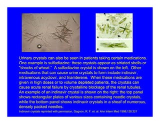 Urinary crystals | PDF