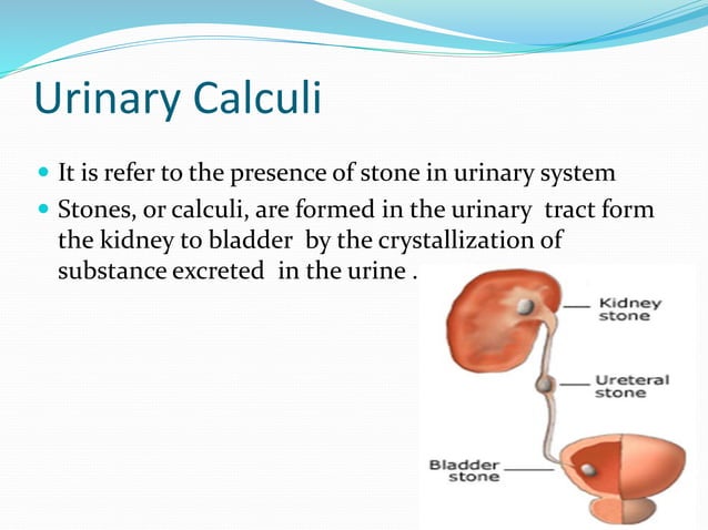 Urinary calculi by waheed | PPTX