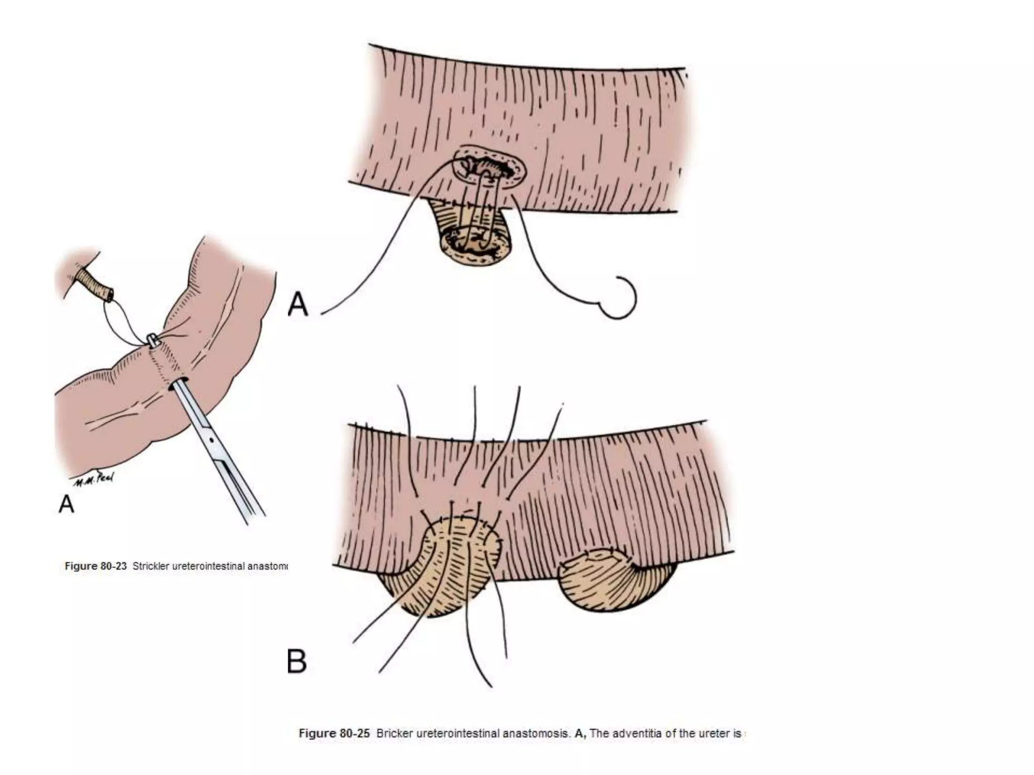 Urinary Diversion | PPTX