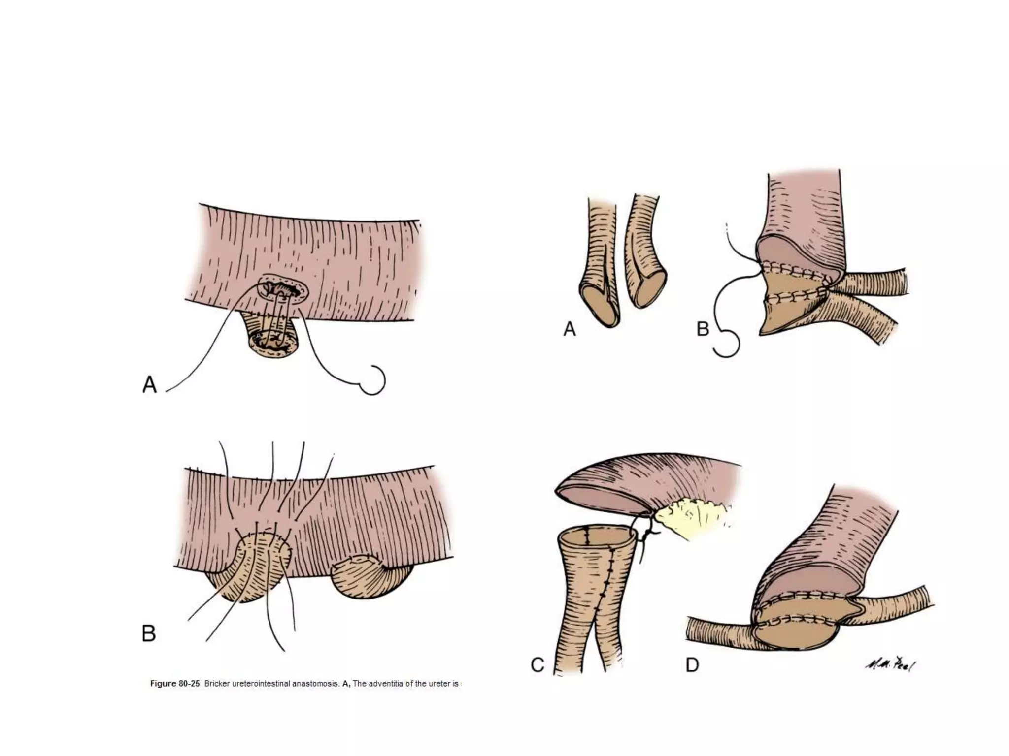 Urinary Diversion | PPTX