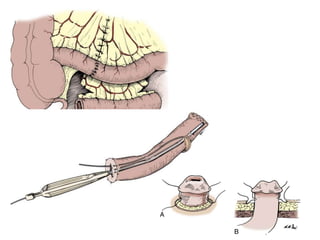 Ureterosigmoidostomy