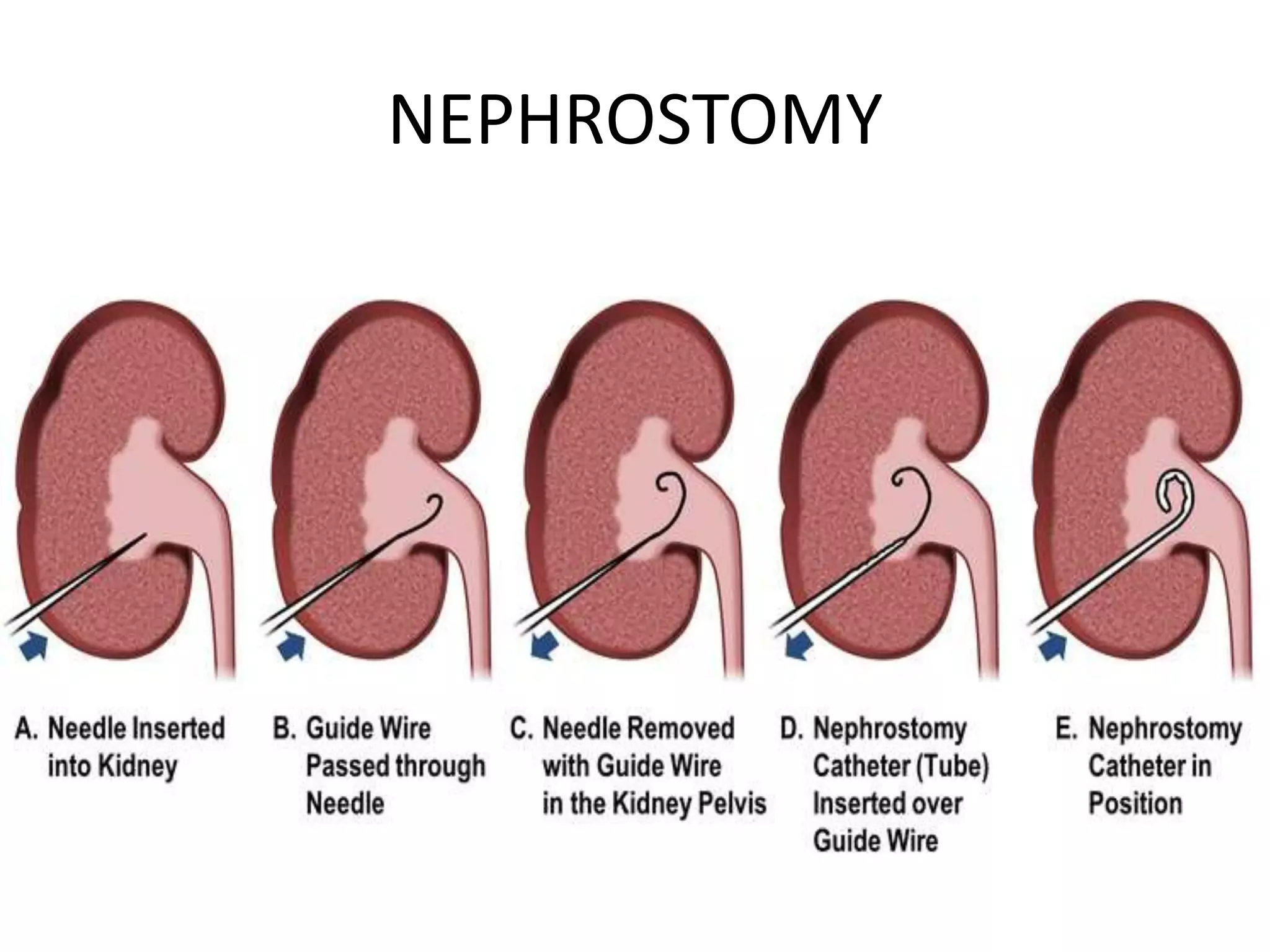Urinary diversion | PPTX