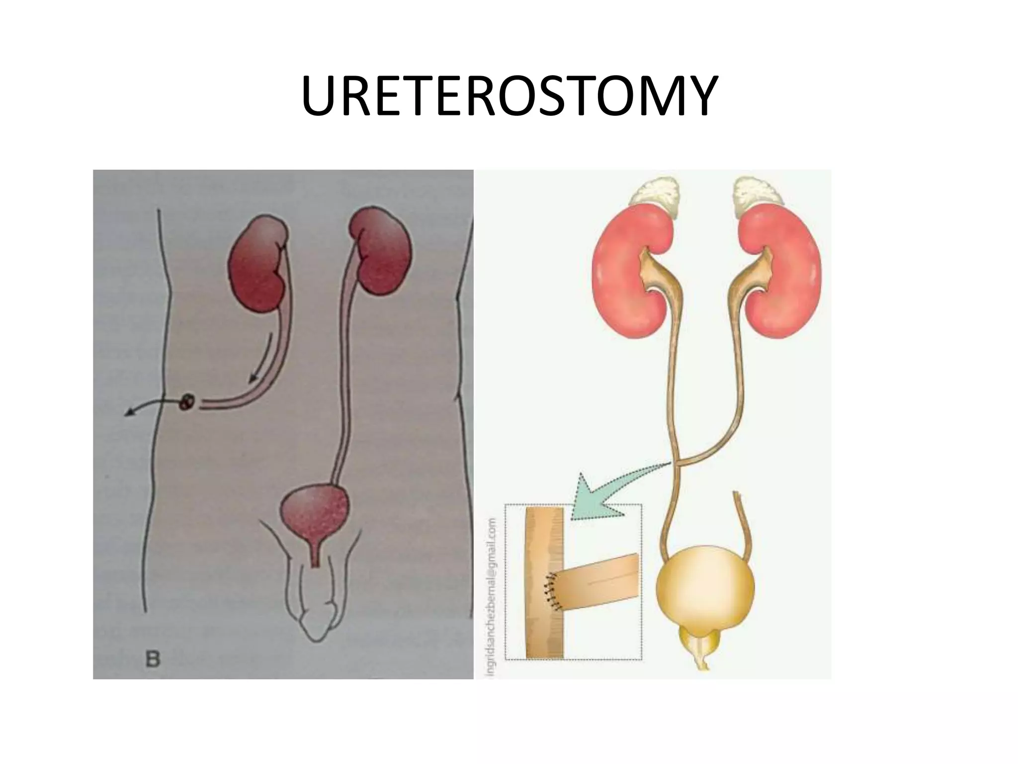 Urinary diversion | PPTX