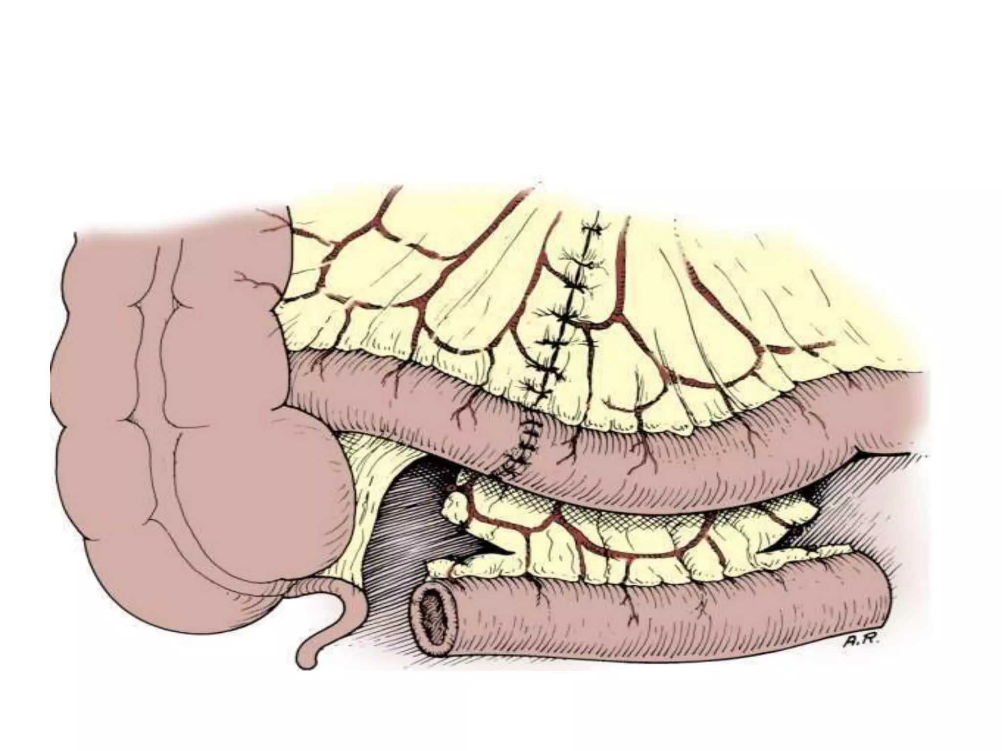 Urinary diversion | PPTX