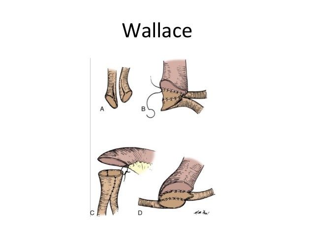 Urinary Diversion after cystectomy [Dr.Edmond Wong]