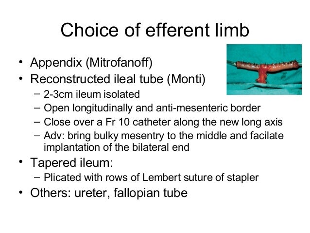 Urinary Diversion after cystectomy [Dr.Edmond Wong]