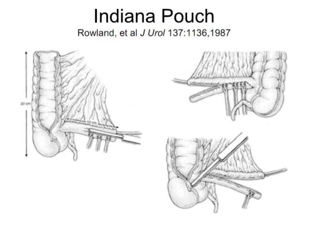 Urinary Diversion after cystectomy [Dr.Edmond Wong]