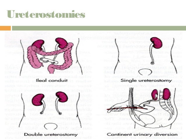 Urinary elimination & Catheters lecture