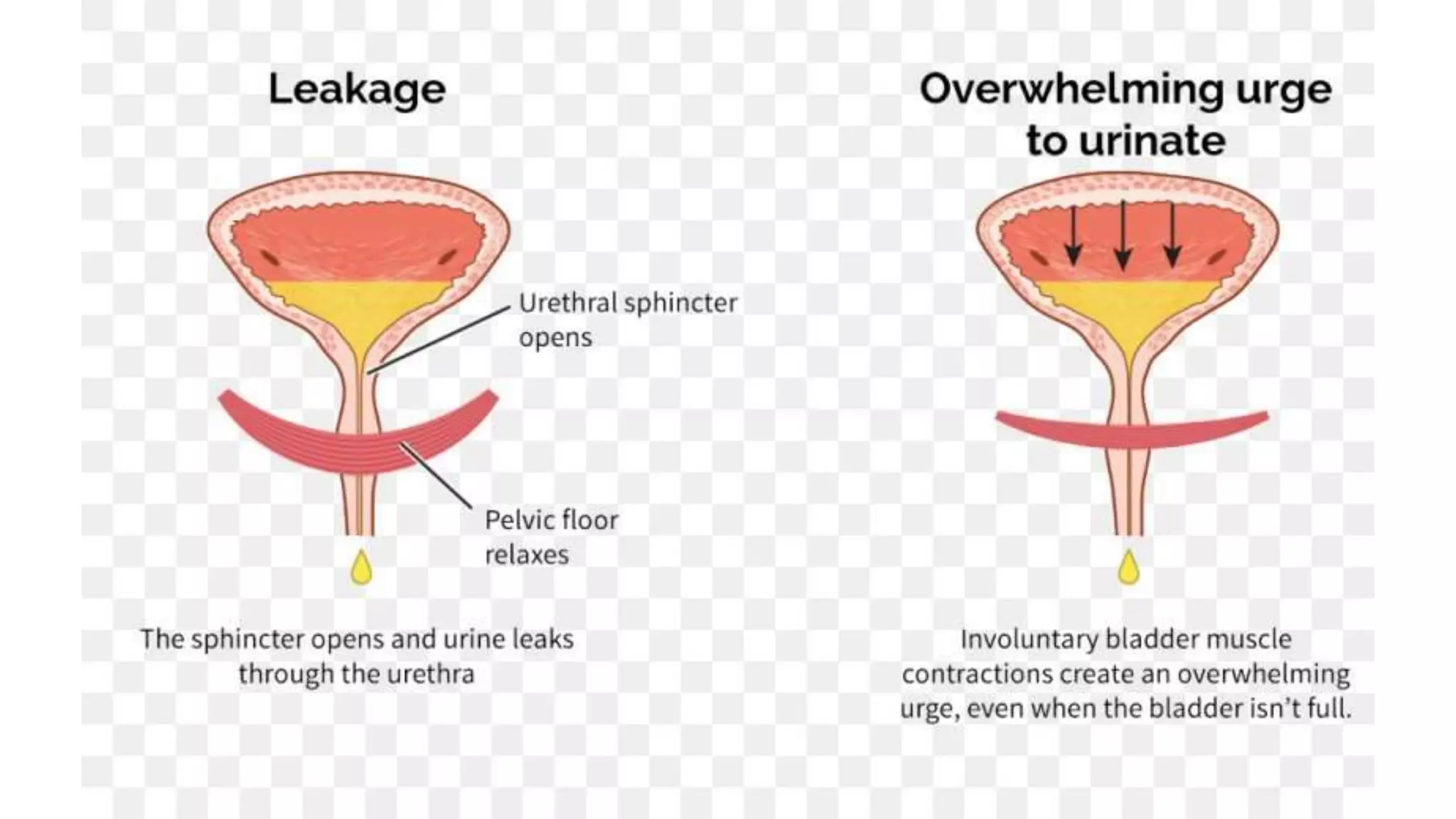 Urinary incontinence and it's PT management | PPTX