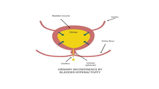 Urinary incontinence and it's PT management | PPTX