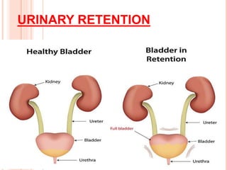 Urinary incontinance & retention of urine , nursing care | PPTX
