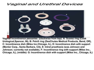 Urinary incontinence | PPT