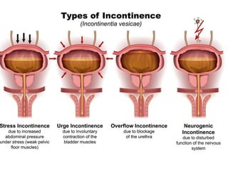 URINARY INCONTINENCE DIAGNOSIS AND MANAGEMENT.ppt