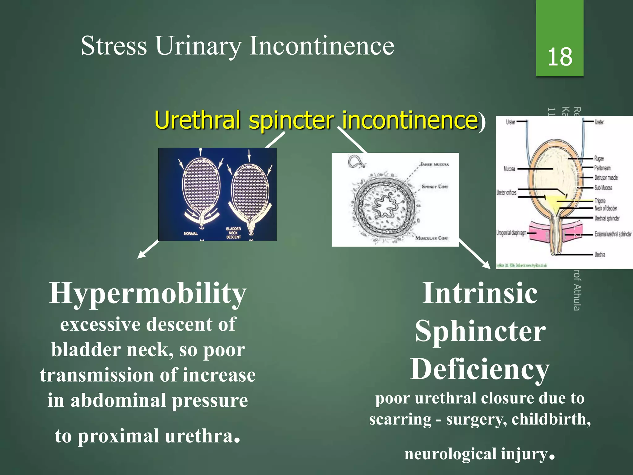 Urinary Incontinence in Females | PPTX