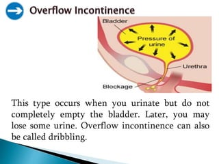 Urinary Incontinence: Types, Causes & Prevention By Unique Wellness | PPTX