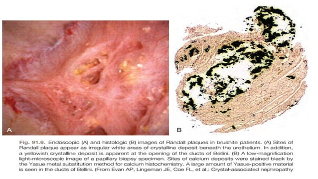 Urinary Lithiasis handout or pg-campbell.pptx