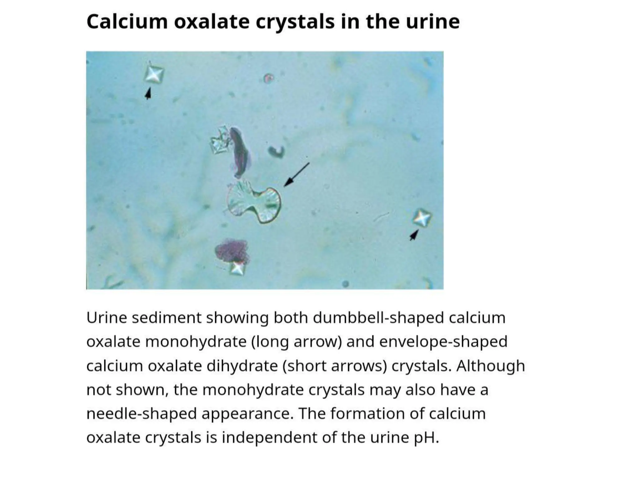 urinary lithiasis etiology , pathogenesis, types of urinary lithiasis .pptx
