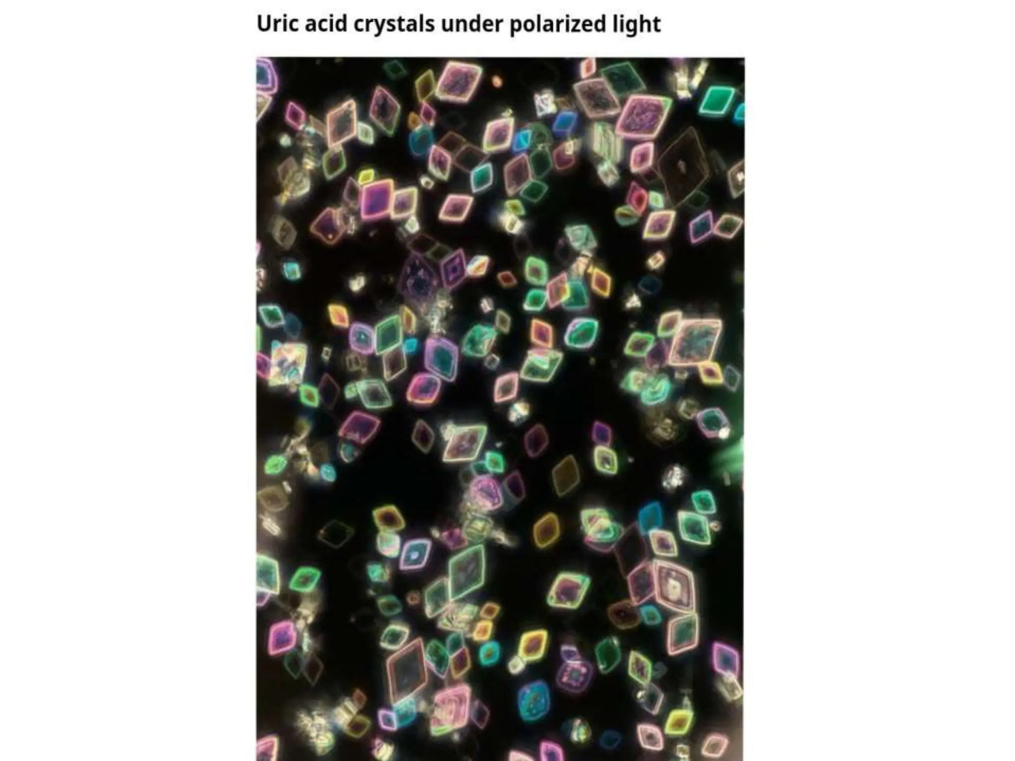 urinary lithiasis etiology , pathogenesis, types of urinary lithiasis .pptx