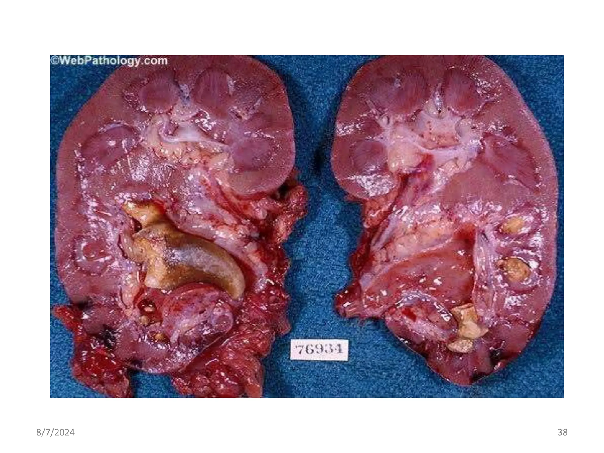 urinary lithiasis etiology , pathogenesis, types of urinary lithiasis .pptx