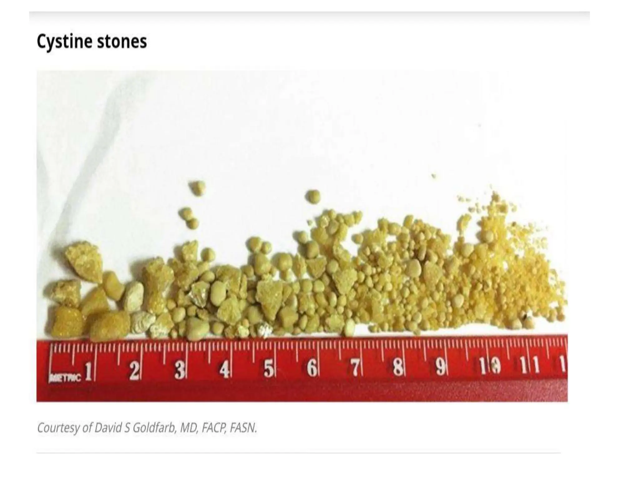 urinary lithiasis etiology , pathogenesis, types of urinary lithiasis .pptx