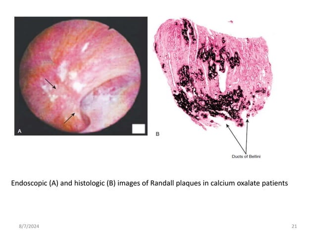 urinary lithiasis etiology , pathogenesis, types of urinary lithiasis .pptx