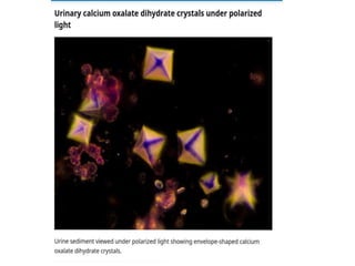 urinary lithiasis etiology , pathogenesis, types of urinary lithiasis .pptx