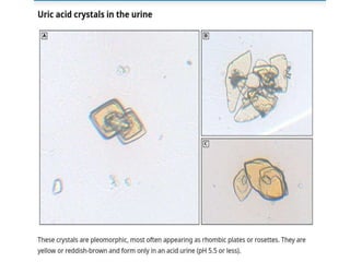urinary lithiasis etiology , pathogenesis, types of urinary lithiasis .pptx