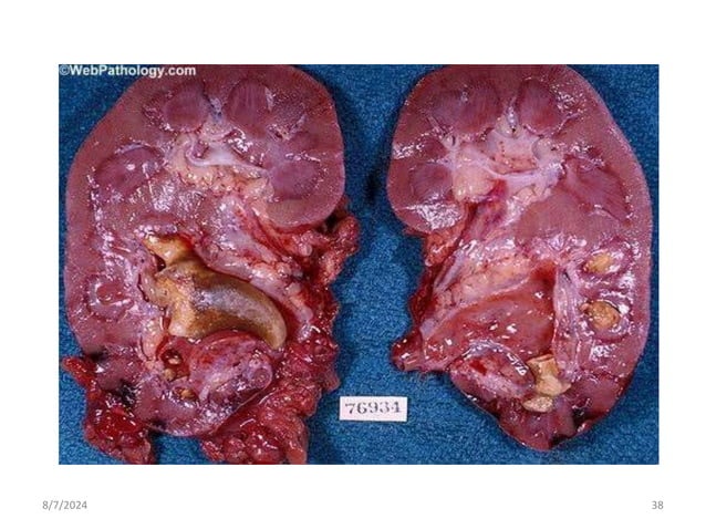 urinary lithiasis etiology , pathogenesis, types of urinary lithiasis .pptx