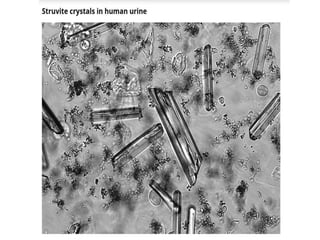 urinary lithiasis etiology , pathogenesis, types of urinary lithiasis .pptx