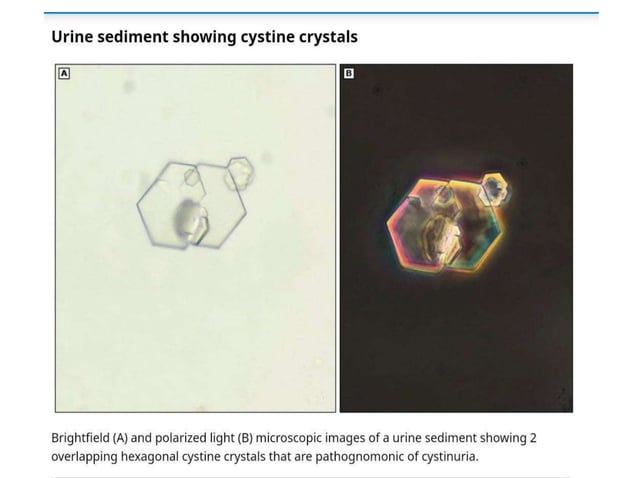 urinary lithiasis etiology , pathogenesis, types of urinary lithiasis .pptx