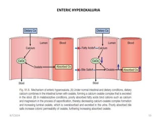 urinary lithiasis etiology , pathogenesis, types of urinary lithiasis .pptx