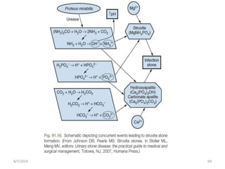 urinary lithiasis etiology , pathogenesis, types of urinary lithiasis .pptx