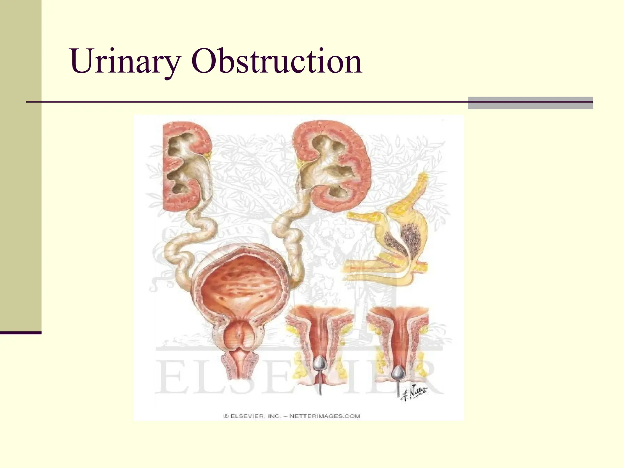 urinary obstruction and benign prostate hyperplasia.ppt