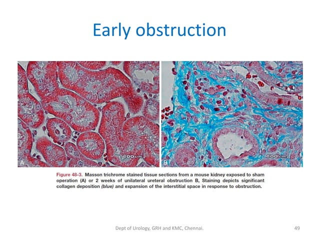 Urinary obstruction pathophysiology | PDF