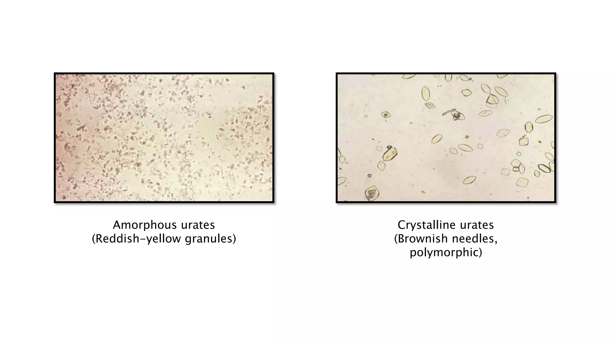 Urinary sediments under microscopic examination | PPTX