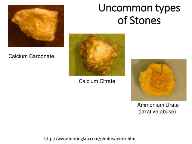 Urinary stone disease