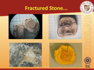 Urinary Stone disease : Metabolic work up and its significaance | PPT