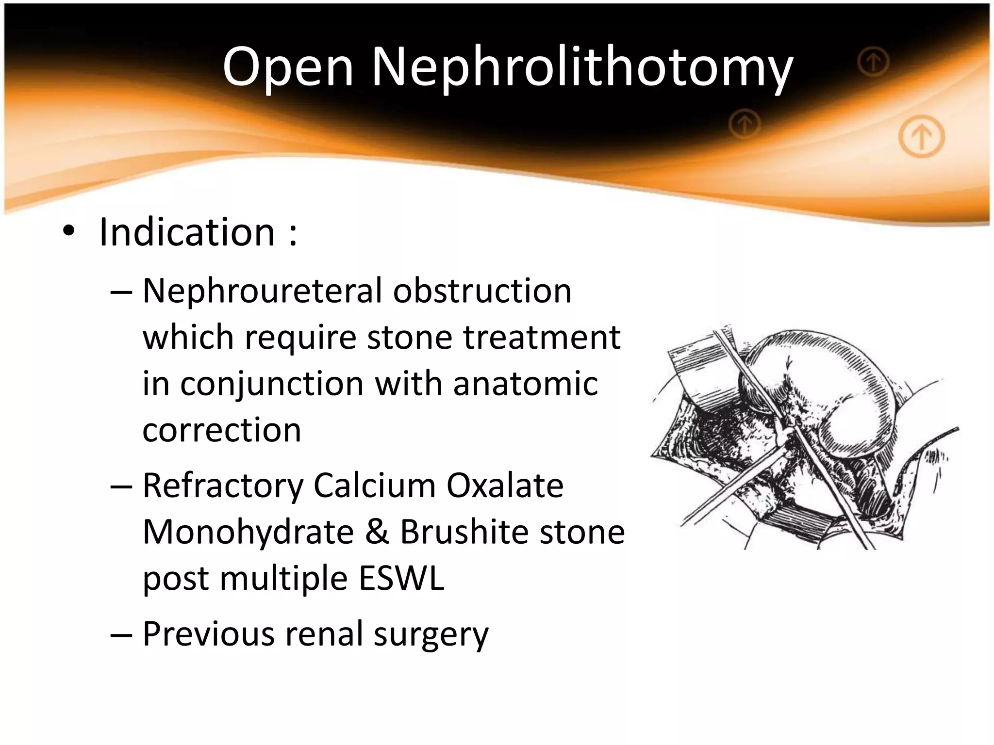 Urinary Stone Management and Infection.pptx