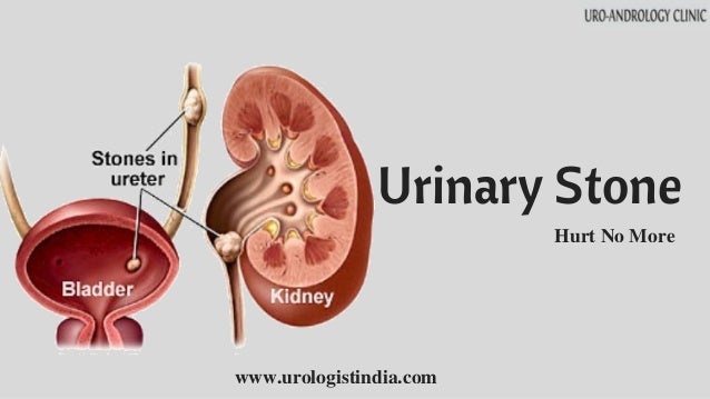 Urinary Stone Treatment In Chennai | Urology Clinic In Tamilnadu