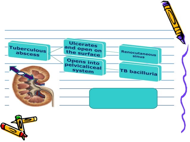URINARY TRACT TUBERCULOSIS | PPTX