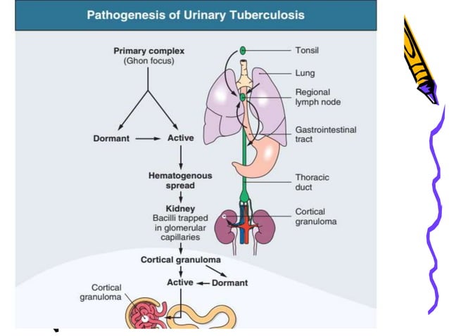 URINARY TRACT TUBERCULOSIS | PPTX