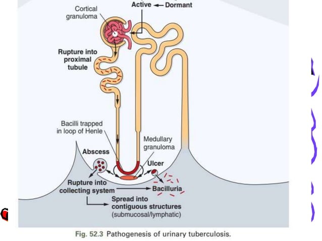 URINARY TRACT TUBERCULOSIS | PPTX
