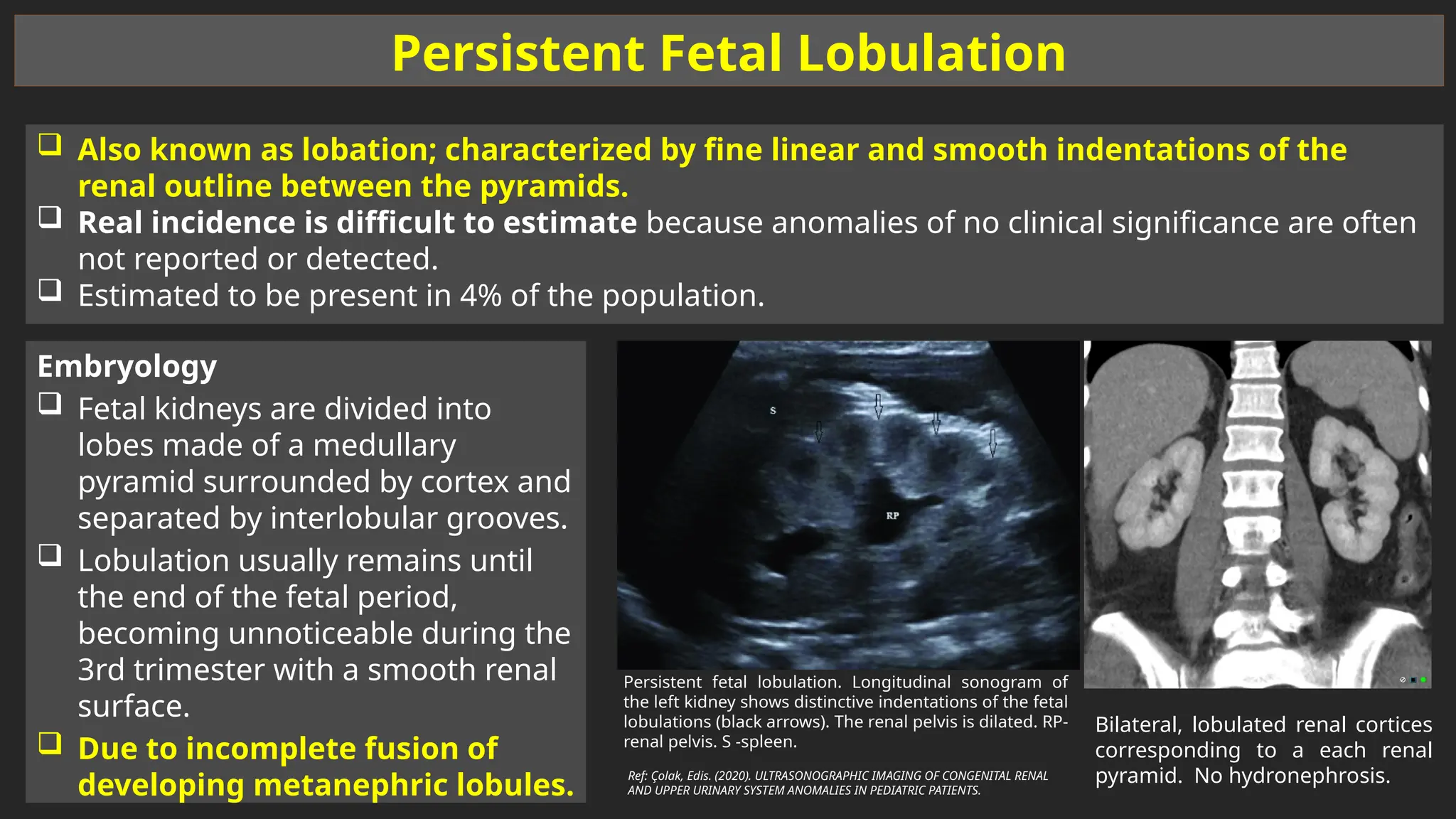 Anatomy of Urinary Tract and Congenital Anomalies – A Radiology ...