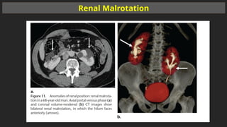 Anatomy of Urinary Tract and Congenital Anomalies – A Radiology ...